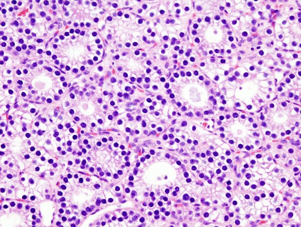 Health And Diseases Blog Adenoma health-and-diseases-blog-adenoma