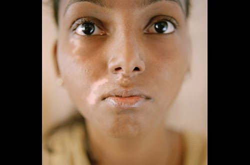 BeautyIsInTheEyesOfMe Waardenburg Syndrome beautyisintheeyesofme-waardenburg-syndrome