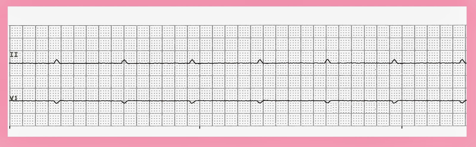 Float Nurse: EKG Rhythm Quiz 246