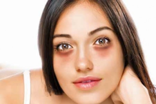 How To Get Rid Of Dark Circles Under Eyes 6 Easy Tips SwellNoMore how-to-get-rid-of-dark-circles-under-eyes-6-easy-tips-swellnomore