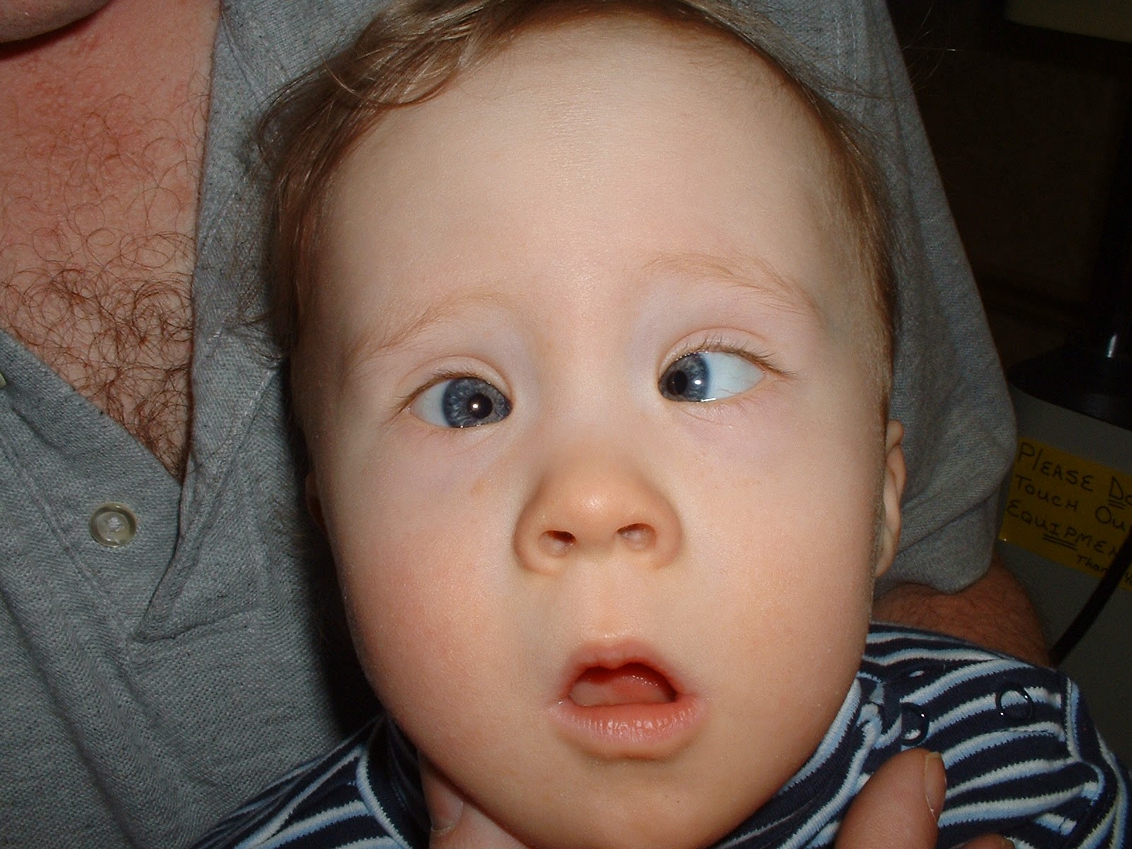 Crossed Eyes Treatment For Babies at Catherine Dorsey blog Crossed Eyes Treatment For Babies at Catherine Dorsey blog