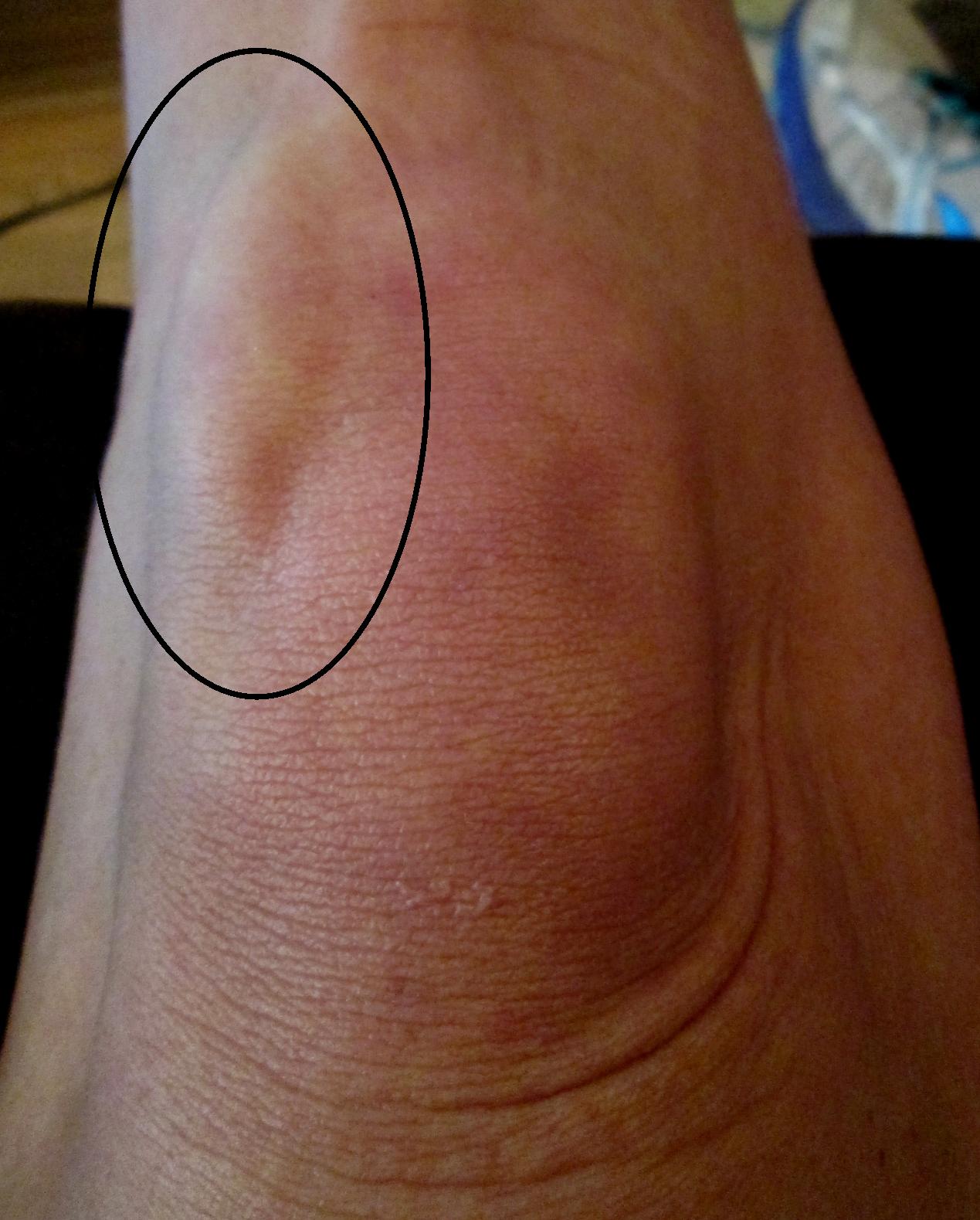 Hard Lump Under Knee Cap No Pain What Supplements To Build Muscle Fast hard-lump-under-knee-cap-no-pain-what-supplements-to-build-muscle-fast