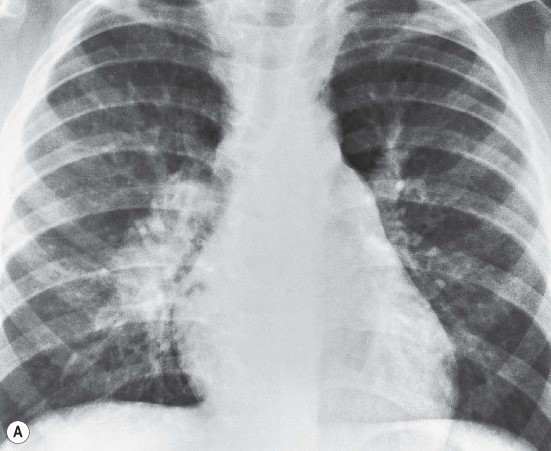 Radiology Pearls: TUBERCULOSIS