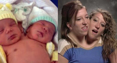 Two heads With 1 Body? How did that happen?! - TodayinPinas