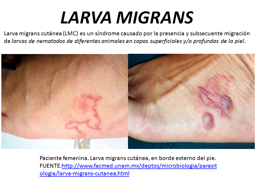PODOLOGIA: LOS PIES SOBRE LA TIERRA: LARVA MIGRANS - Fuente:UNAM