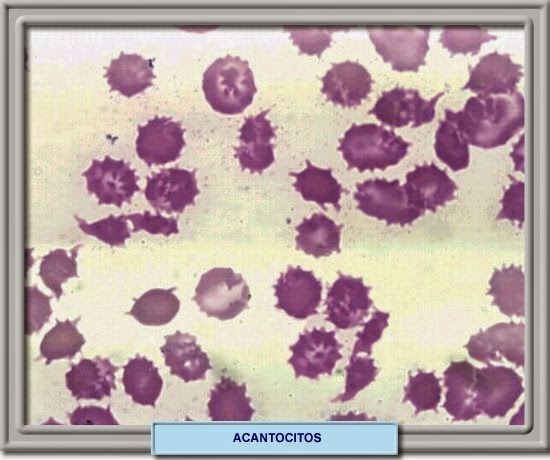 FICHERO DE HEMATOLOGIA: ACANTOCITOS