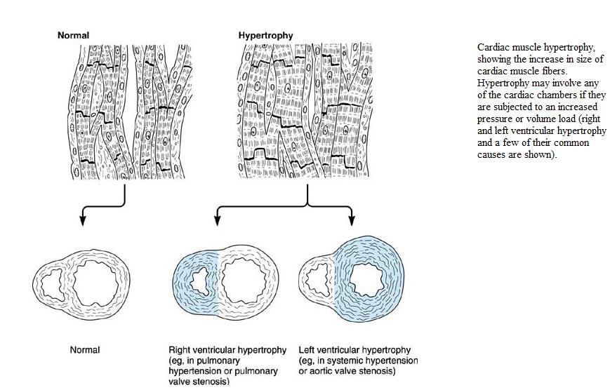 MBBS Medicine (Humanity First): Neoplasia : Differentiation and anaplasia MBBS Medicine (Humanity First): Neoplasia : Differentiation and anaplasia