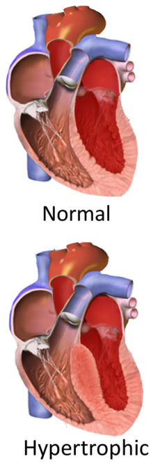 Donald Lepp My World What Is Hypertrophic Obstructive Cardiomyopathy HOCM donald-lepp-my-world-what-is-hypertrophic-obstructive-cardiomyopathy-hocm