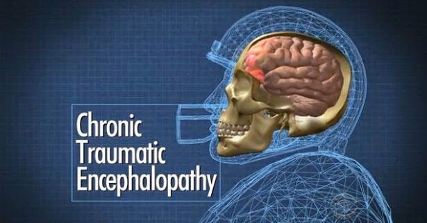 Alzheimer s Dementia Weekly Blood Test Spots CTE Dementia alzheimer-s-dementia-weekly-blood-test-spots-cte-dementia