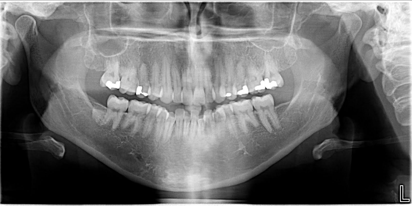 Jaw Bone Infection X Ray at Beth Heard blog Jaw Bone Infection X Ray at Beth Heard blog