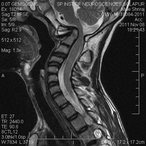 Neuroradiology Cases: Basilar Impression (BI)