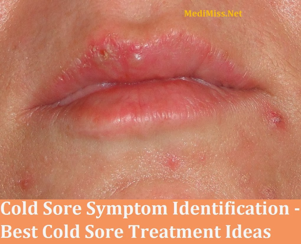 Cold Sore Symptom Identification Best Cold Sore Treatment Ideas cold-sore-symptom-identification-best-cold-sore-treatment-ideas