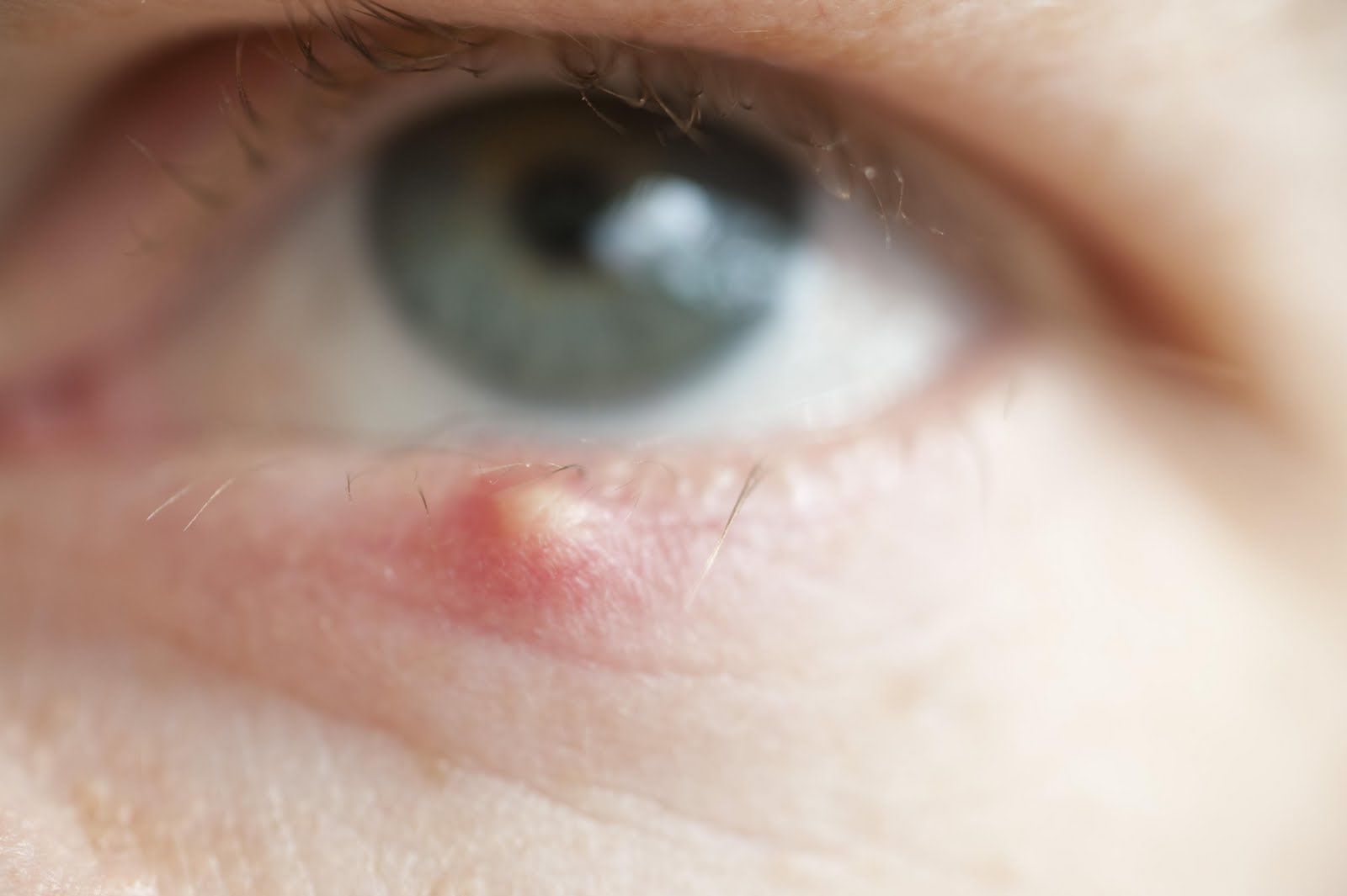 Concept Of Chalazion And Stye Its Management And Treatment Free concept-of-chalazion-and-stye-its-management-and-treatment-free