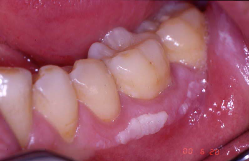 Leukoplakia Definition Epidemiology Clinical Presentation leukoplakia-definition-epidemiology-clinical-presentation