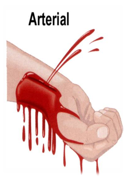Primeros auxilios: Clasificacion de hemorragia