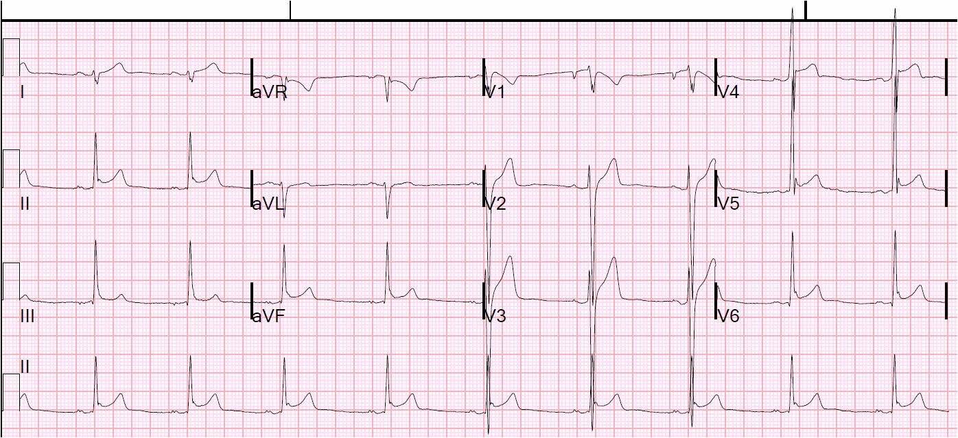 Dr Smith s ECG Blog Even With STE In V5 V6 Inferior STE Without dr-smith-s-ecg-blog-even-with-ste-in-v5-v6-inferior-ste-without