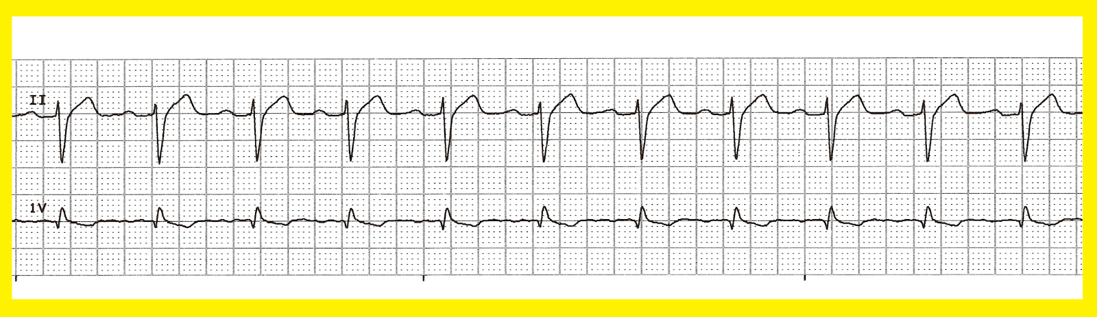 Float Nurse Practice EKG Strips 390 float-nurse-practice-ekg-strips-390