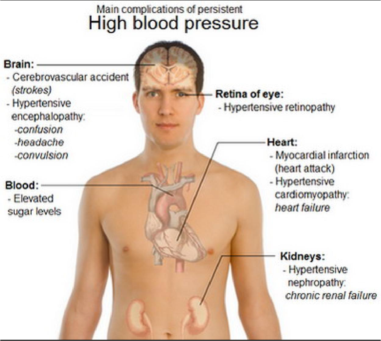 A WAHMpire s Diary TEKANAN DARAH TINGGI HYPERTENSION a-wahmpire-s-diary-tekanan-darah-tinggi-hypertension