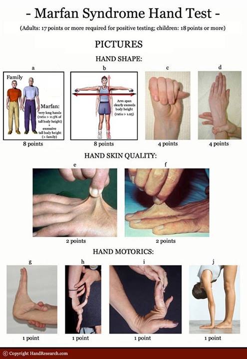 ladanzaynuestrocuerpo: ACERCA DEL SINDROME DE MARFAN ladanzaynuestrocuerpo: ACERCA DEL SINDROME DE MARFAN