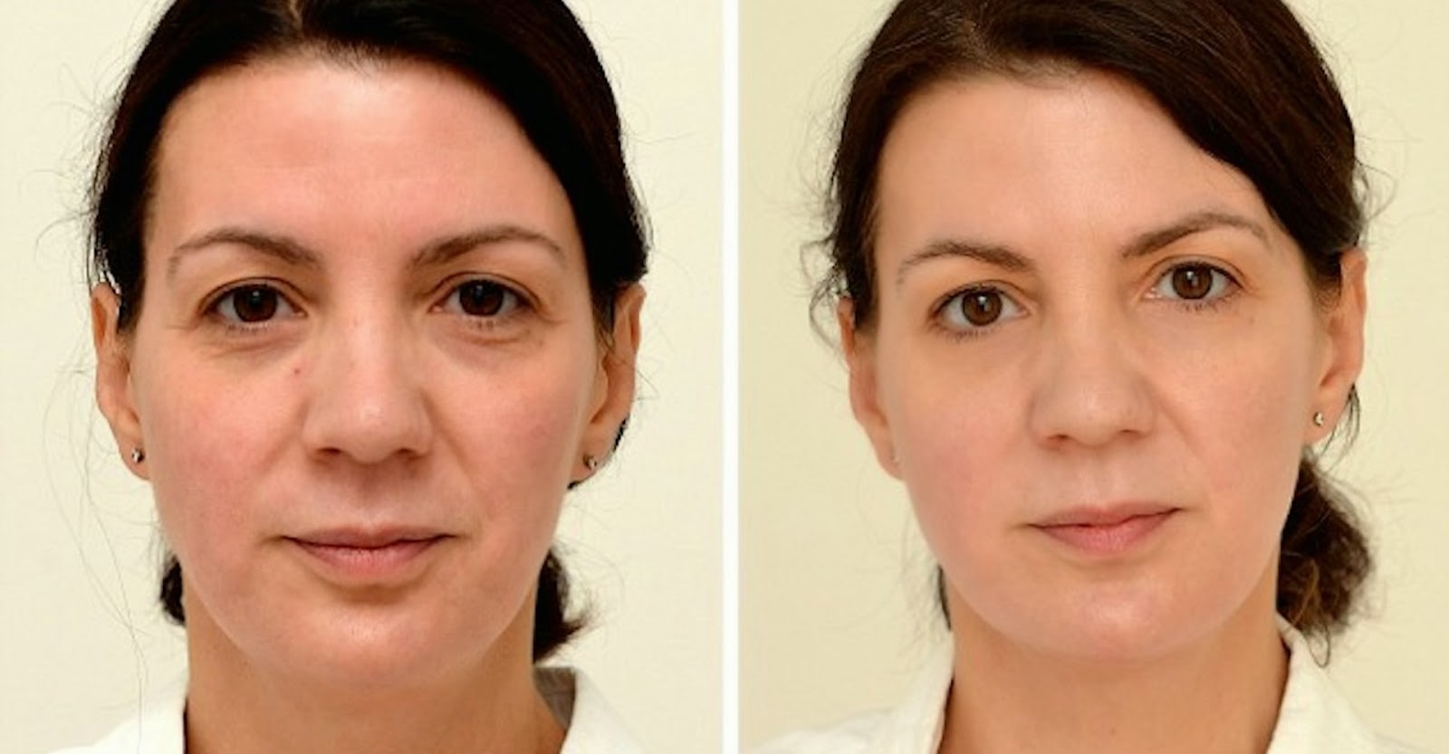 Woman Drank 3 Liters Of Water Per Day After Just 4 Weeks Her Results woman-drank-3-liters-of-water-per-day-after-just-4-weeks-her-results