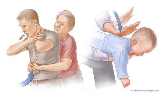 CARTILHA DE PRIMEIROS SOCORROS: ENGASGO