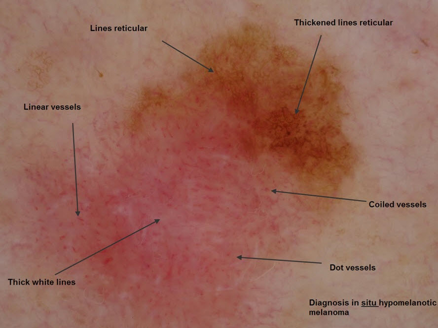 Dermoscopy Made Simple Clues To Melanoma dermoscopy-made-simple-clues-to-melanoma