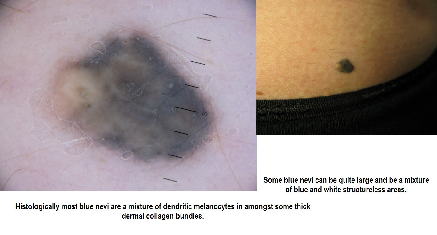 Dermoscopy Made Simple: Blue nevus