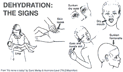 Experiencing Baby Signs Dehydration ~ Woman & Marriage