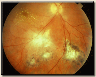 Toxoplasmose Ocular ~ Olhos Vermelhos - o que pode ser