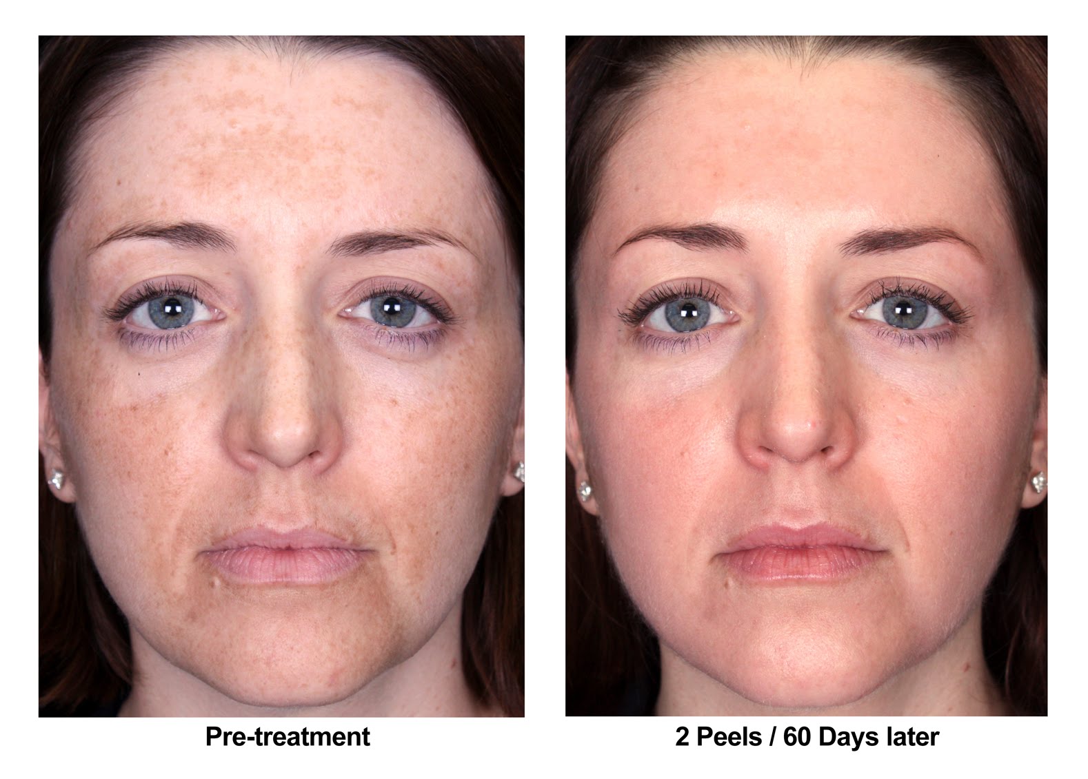 Cosmetic and Aesthetic Surgery: Dream Peel Questions Answered Cosmetic and Aesthetic Surgery: Dream Peel Questions Answered