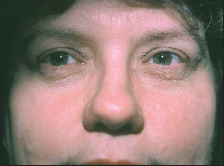 Bumps Around Eyes bumps-around-eyes