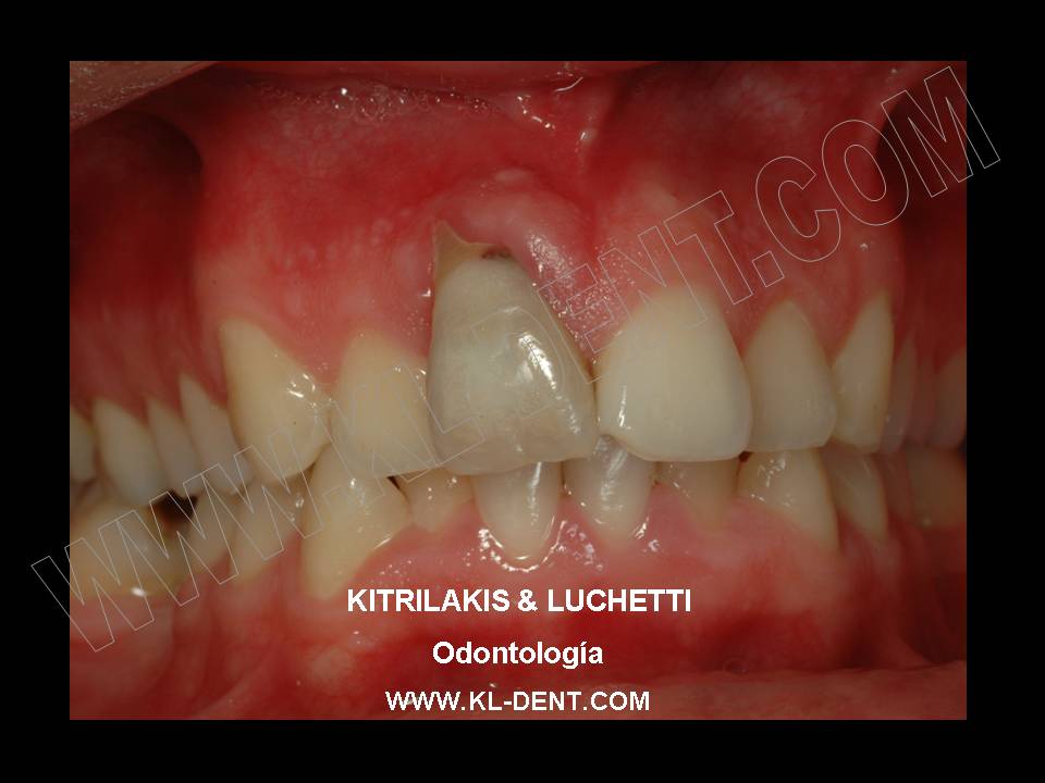 Kitrilakis & Luchetti - Dentistry: Dental Implant in Upper Central ... Kitrilakis & Luchetti - Dentistry: Dental Implant in Upper Central ...