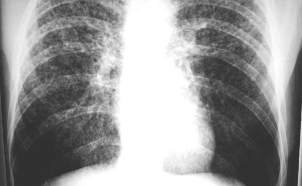 O Radiologista: Padrão Pulmonar Miliar