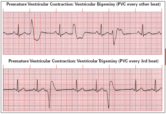 Ventrikel Ekstra sistole ( VES ) - MUZARRO