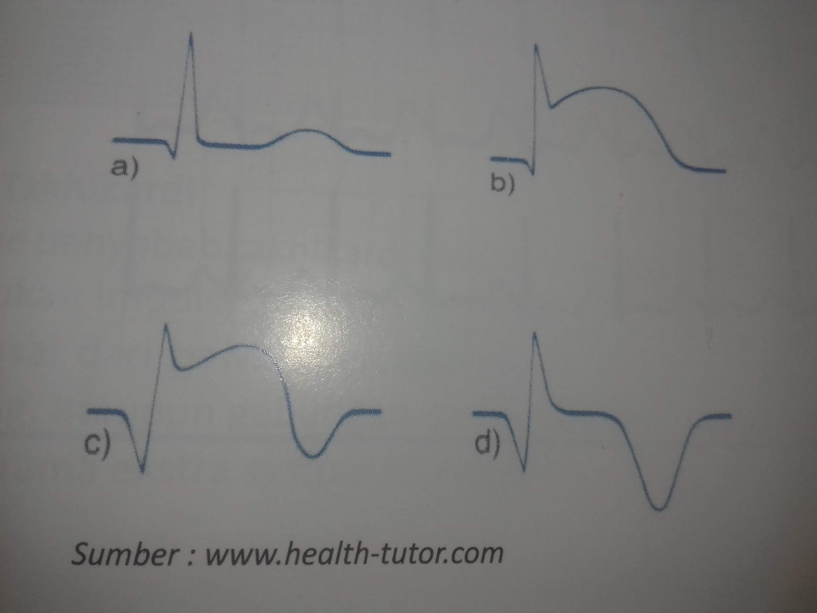 StudentVillage : LAPORAN PENDAHULUAN ST ELEVASI MIOKARD INFARK (STEMI)