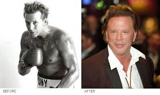 Mickey Rourke Plastic Surgery