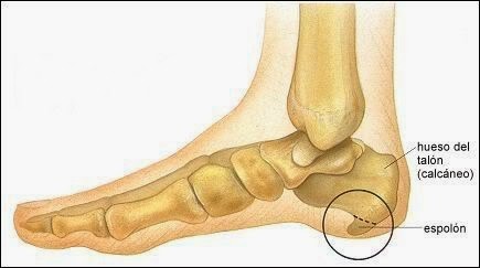 Fascitis Plantar: Espolón Calcaneo, que es, causas y tratamiento