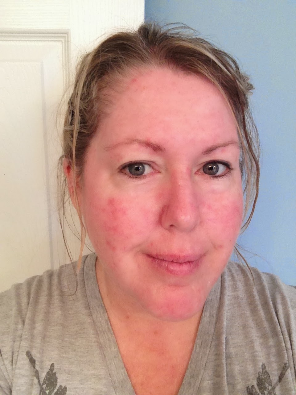 My Journey Through Topical Chemotherapy - Fluorouracil 5% Cream and ...