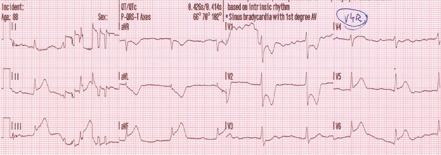 ECGs for EMS: Identification and localization of STEMI: POSTERIOR WALL