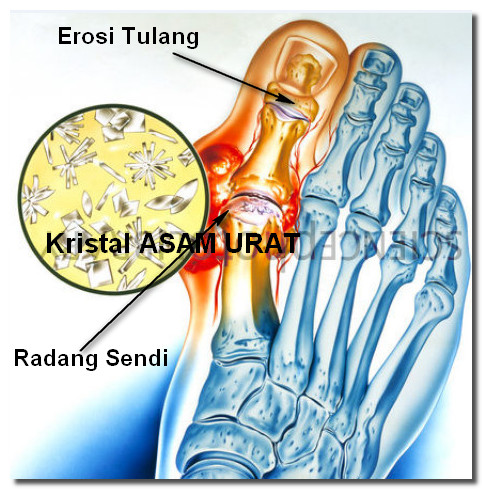Makanan Untuk Asam Urat | WAWAI DIET LAMPUNG