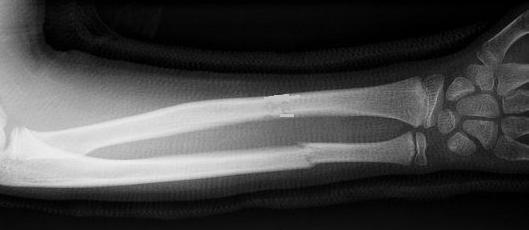 Terlingua or Bust: Broken Arm