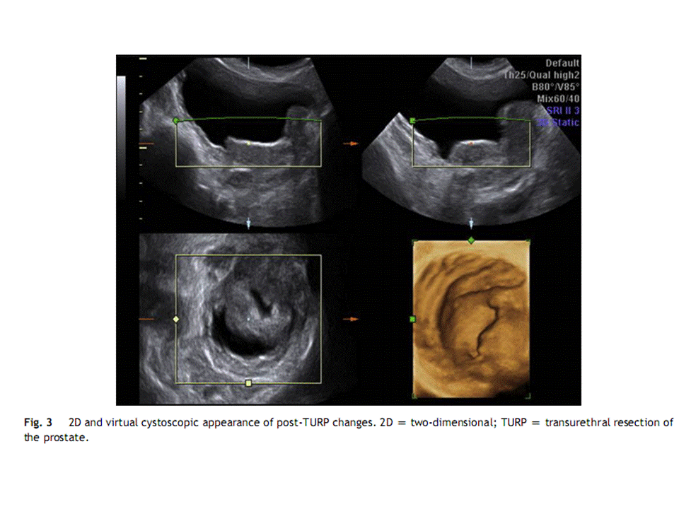 BÀI SOẠN VỀ SIÊU ÂM CHẨN ĐOÁN: VIRTUAL CYSTOSCOPY USING 3D ULTRASOUND