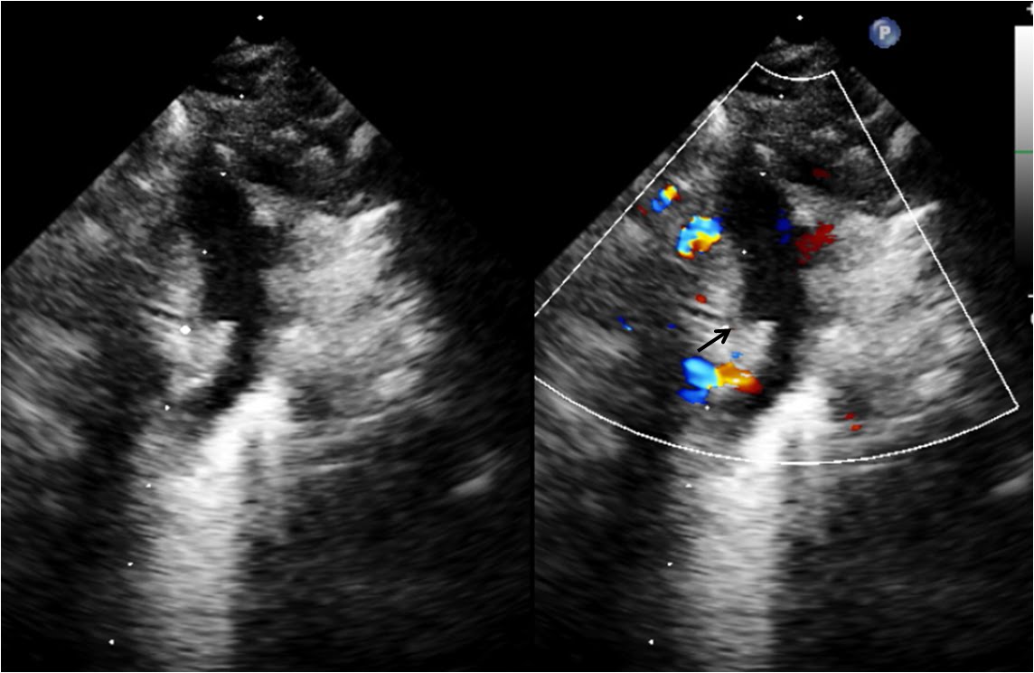 Pedi cardiology: Echo: What is shown by black arrow?