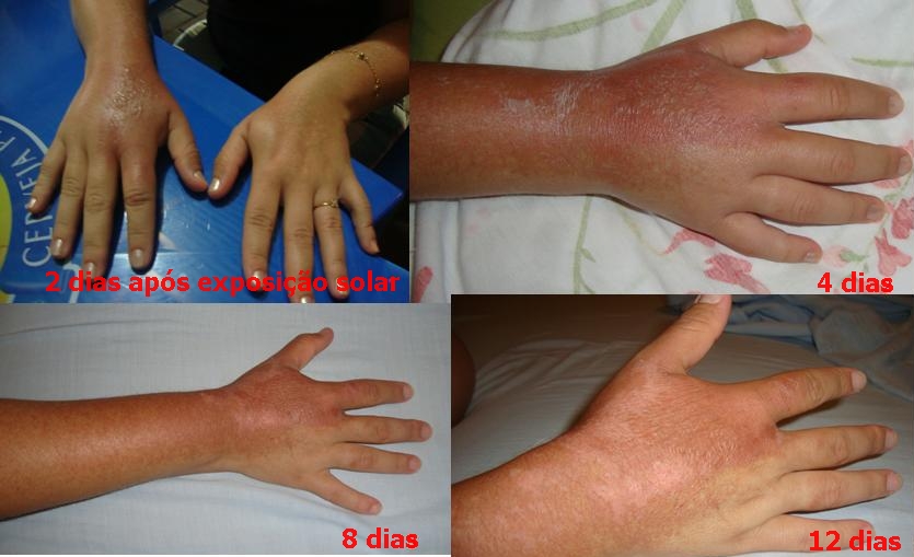 Essa tal vaidade: Fitofotodermatose