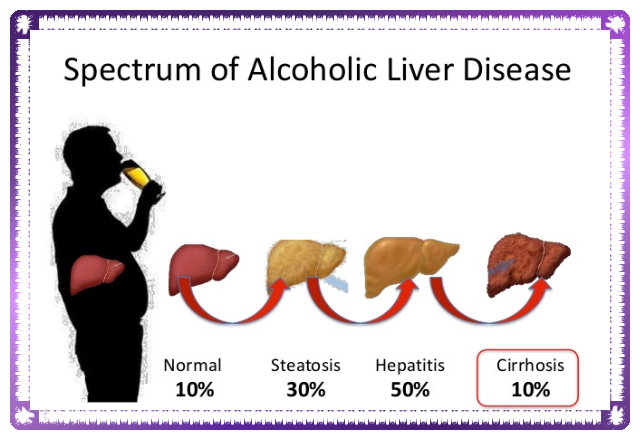 Alcoholic liver disease - Sure Developers Team