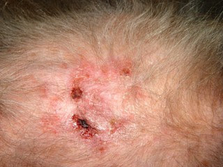 Pictures of skin cancer: Skin cancer on scalp pictures