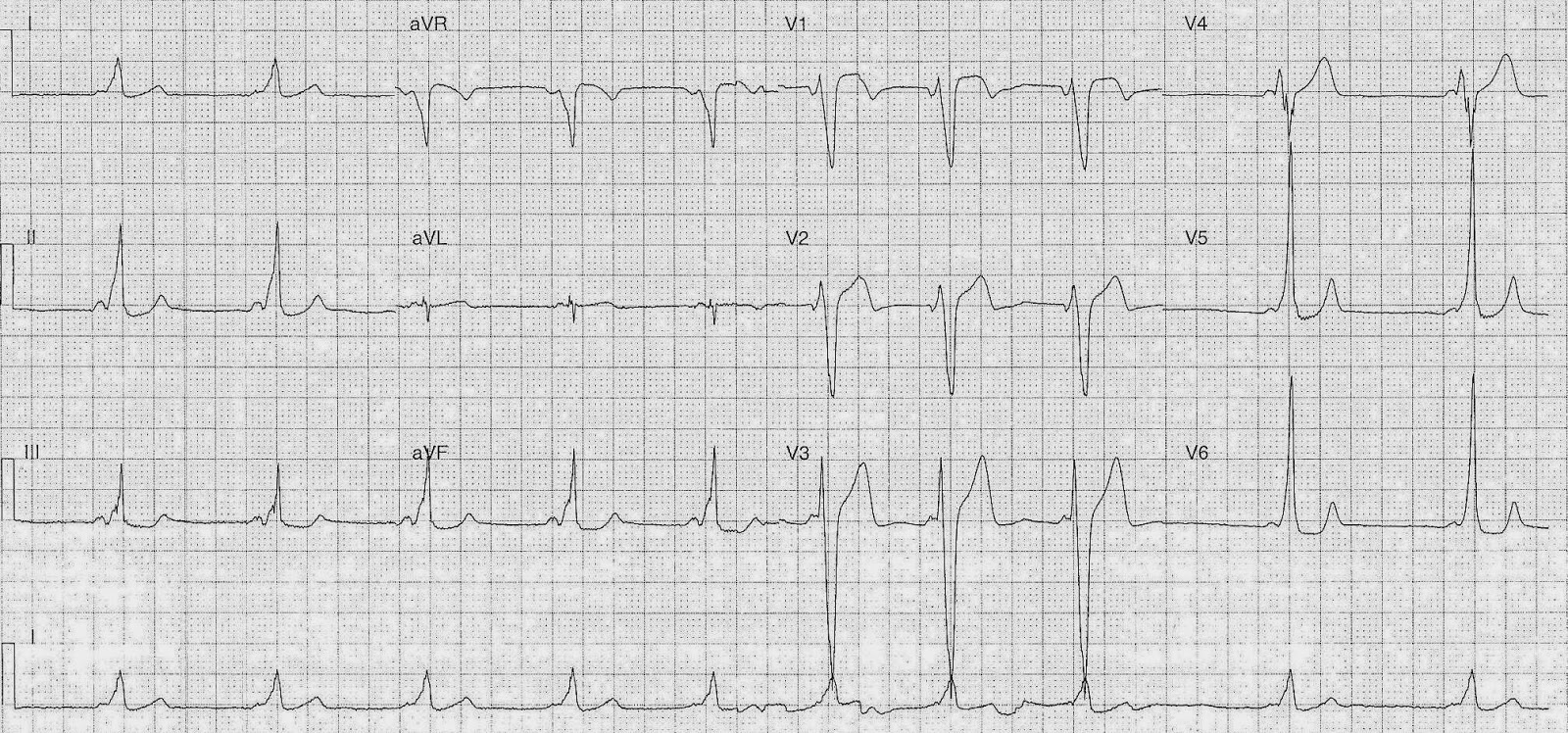 ECG of the Week: ECG of the Week - 25th August 2014 - Interpretation