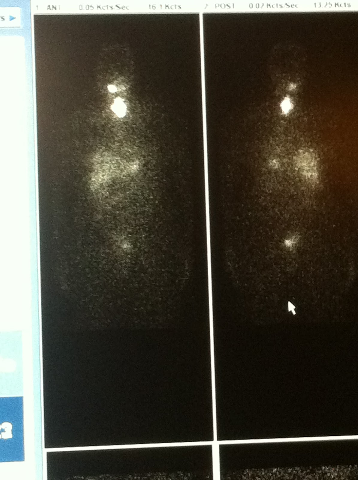 My Journey with Thyroid Cancer: Post RAI scans