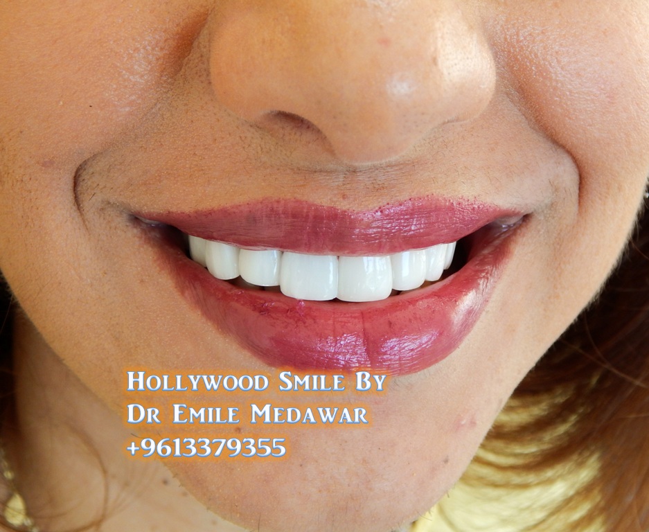 Beirut Veneer, Dr Emile Medawar, 00 961 3 379355: Hollywood Smile ...