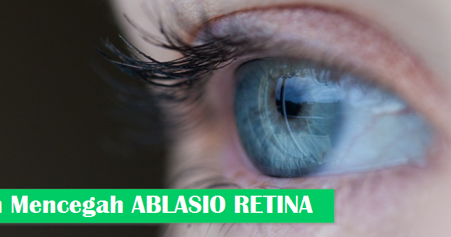 Pengalaman Operasi Ablasio Retina, Mengenal Gejala Dan Pengobatannya ...